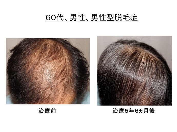 男性型脱毛症は、徐々に、しかし、確実に改善していきます！ 患者様からの声・メディア掲載・クリニックからのお知らせ 名古屋kクリニック